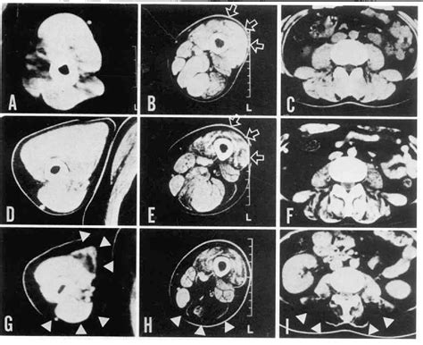 Figure 2 From Quadriceps Myopathy Becker Muscular Semantic Scholar
