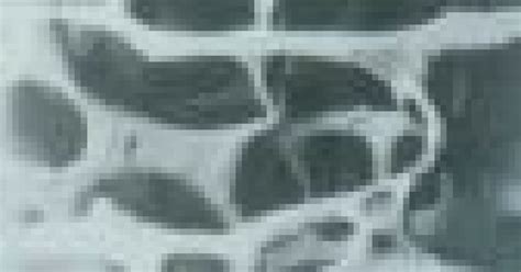 골다공증 치료중 정기적인 골밀도검사 불필요