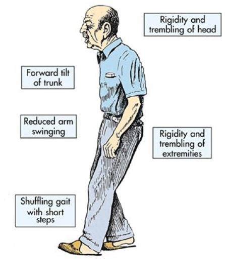 Hypokinesia Bradykinesia Hypodynamia