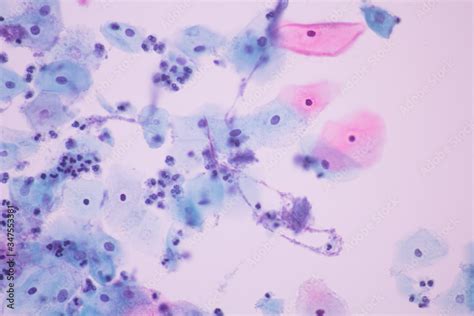 View In Microscopic Of Candidiasis Fungus Infection Yeast And Hot Sex