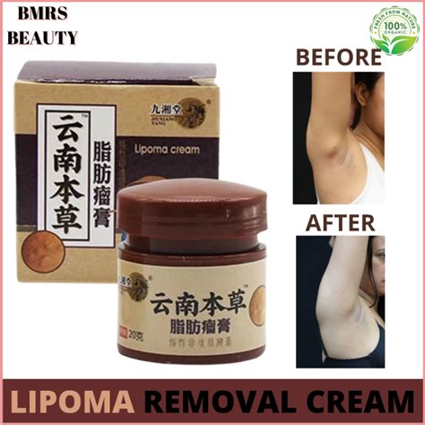 Fast Effect On Hand Lipoma Removal Cream Treat Tumor Skin Swelling