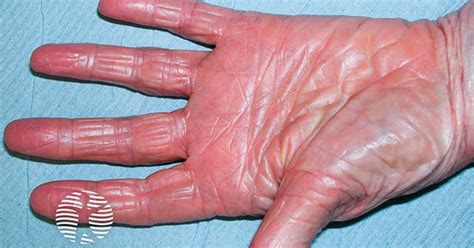 Acquired Palmoplantar Keratoderma Image