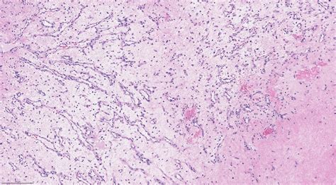 Nasopharyngeal Angiofibroma Histology Metarteriole And Mesenchyme