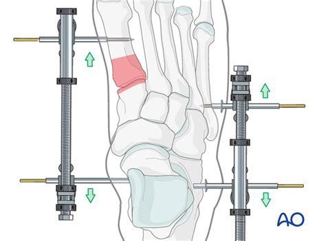 Dorsal Spanning Plate Fixation Of The Tarsometatarsal Joint