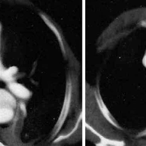 Computed Tomography Scans Showing Dissection Of The Descending Aorta