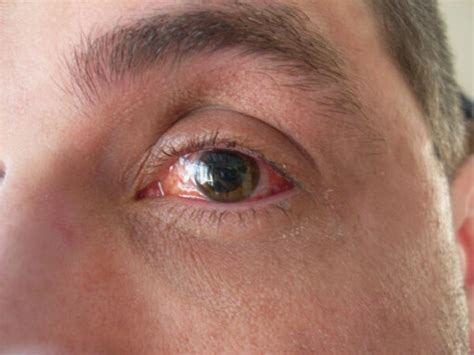 What Is Lattice Degeneration Brooks Eye Associates