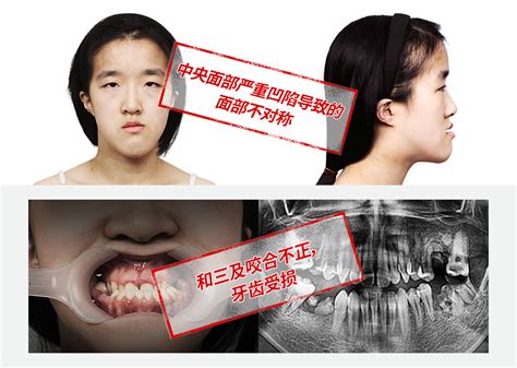 姜恩惠 id整形医院