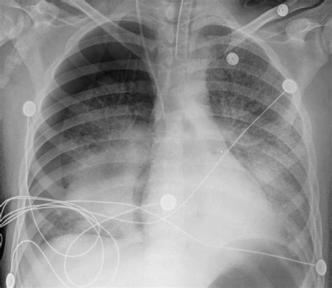 Respiratory Emergencies Flashcards Quizlet