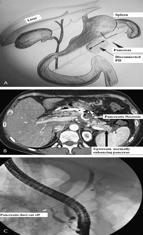Disconnected Pancreatic Duct Syndrome Endoscopic Stent Or S Pancreas