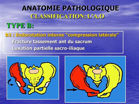 Les Fractures Du Bassin Ppt Video Online Télécharger