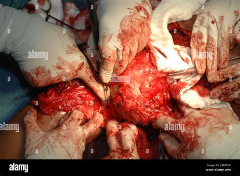 Pictured Is A Man Undergoing Surgery To Remove Fibrosarcoma Fibrosarcoma Fibroblastic Sarcoma