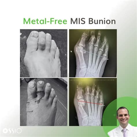 Daniel Popowitz Dpm Facfas On Linkedin I Was Asked To Mention My Post