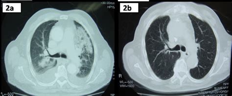 Chest Hrct Scans A Chest Hrct Scan Demonstrating Bilateral