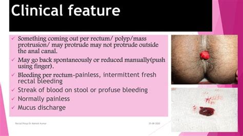 Rectal Polyp Ppt 25 08 2020 Dr Mahesh Pdf Digestive Disorders
