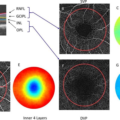 Tissue Volumes And Vessel Densities Of The Intraretinal Layers A