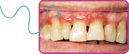 Inflamed Gums Enikam Com