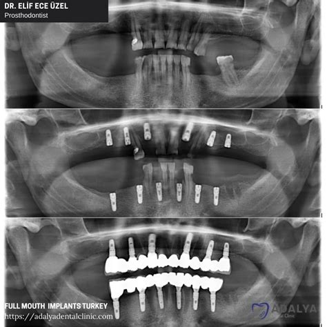 Full Mouth Dental Implants Turkey Package Deals Full Set Implants Cost