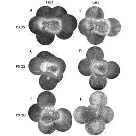 Fundus Colour Photographs From The First And Last Visits Of A Patient Download Scientific