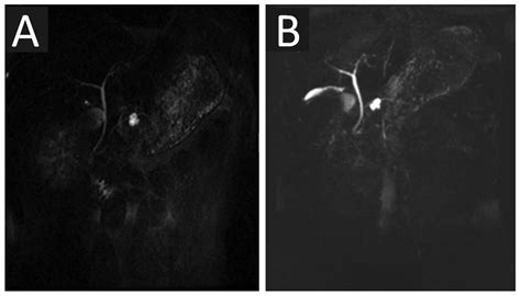 Magnetic Resonance Cholangiopancreatography Comparison Of Two And Three Dimensional Sequences
