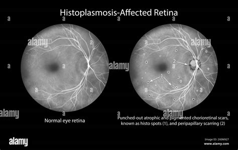 Illustration Of A Retina Affected By Presumed Ocular Histoplasmosis