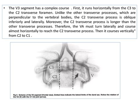 General Anatomy Of The Vertebral Artery Pptx