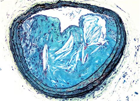 Cross Section Of Advanced Athe Image Eurekalert Science News Releases