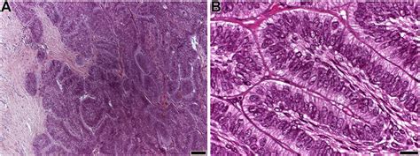 Histopathology Exam Histological Sections Revealed Fragments Of The