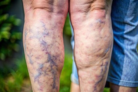 Varicose Veins On A Female Legs Premium AI Generated Image