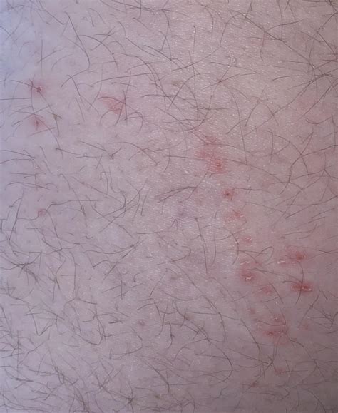 Are These Bed Bug Bites R Bugbites