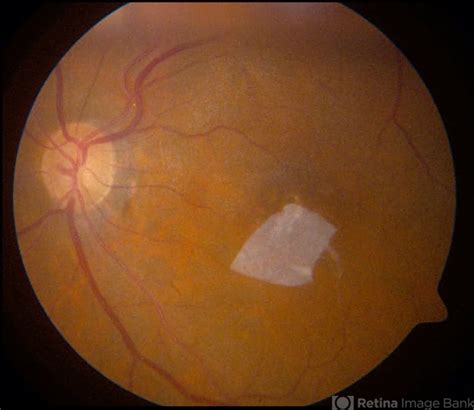 Full Thickness Macular Hole Retina Image Bank