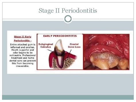 Periodontal Disease Normal Periodontium Remember Which Structures Make