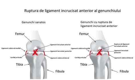 Ruptura Ligament Incrucisat Anterior Lia Cauze And Tratament Dr