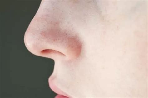 Ampuh Ini Cara Menghilangkan Komedo Di Hidung Secara Cepat Dan Alami