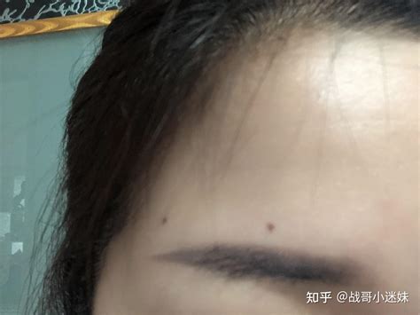 知乎大神多，请问这两个位置痣好不好，想打掉 知乎