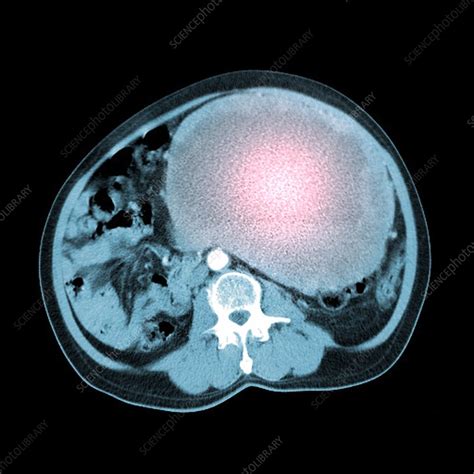 Abdominal Sarcoma Mri Scan Stock Image C011 9572 Science Photo