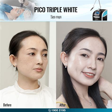 Pico Triple White Công Nghệ Điều Trị Da Toàn Diện Số 1