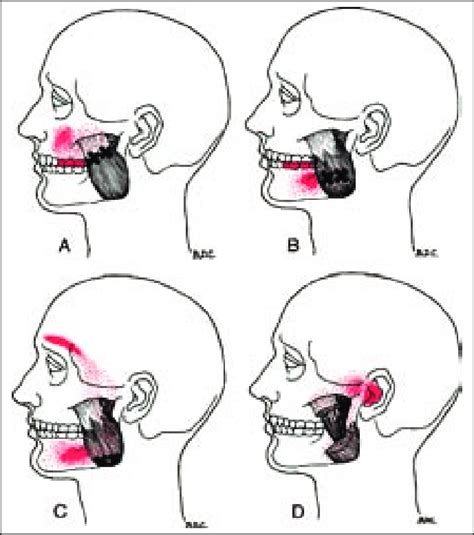 Abcd The Solid Red Shows The Essential Referred Pain Pattern From