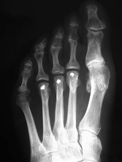 Metatarsal Head Resection