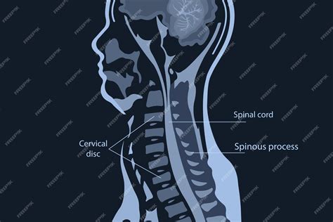 Premium Vector Magnetic Resonance Imaging Of The Cervical Spine Spine