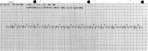 41 Atrial Flutter Paramedicine 101