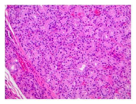Nodular Hyperplasia Of The Thyroid A Secondary To The Patients