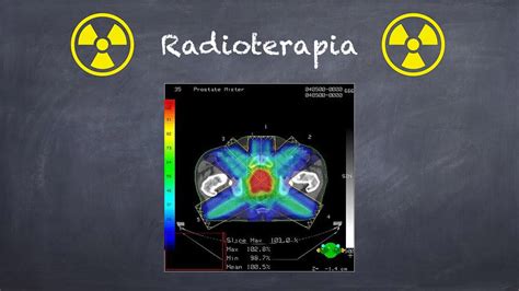 Radioterapia Youtube