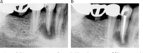 Figure 2 From Ledging And Blockage Of Root Canals During Canal