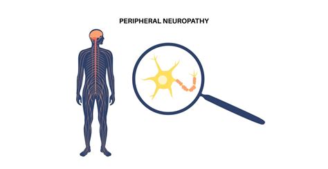 Peripheral Neuropathy Medical Poster Royalty Free Vector