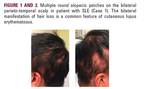 Differentiating And Managing Cutaneous Lupus Erythematosus Associated Alopecia And Patchy