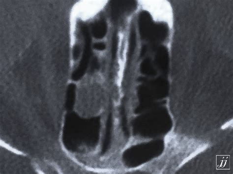 Ent Deep Anterior Cranial Fossa And Mucocele In Lamina Cribrosa 4 Radioogle