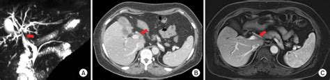 Patient 6 Perihilar Cholangiocarcinoma With Prolonged Chemotherapy And