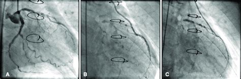 Representative Angiographic Images Obtained Preoperatively A Early