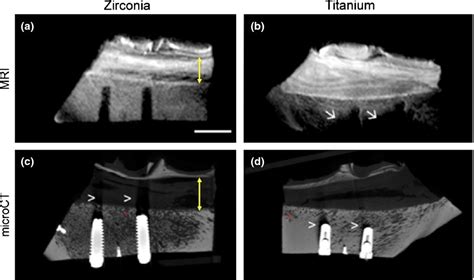 Magnetic Resonance Imaging In Zirconia‐based Dental Implantology