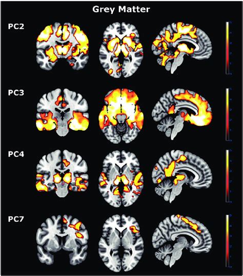 Grey Matter Voxel Based Morphology Imaging Results Voxel Based